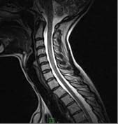 New Algorithm for Detection of Spinal Cord Tumor using OpenCV