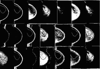 Human Vision Inspired Technique Applied to Detect Suspicious Masses in ...